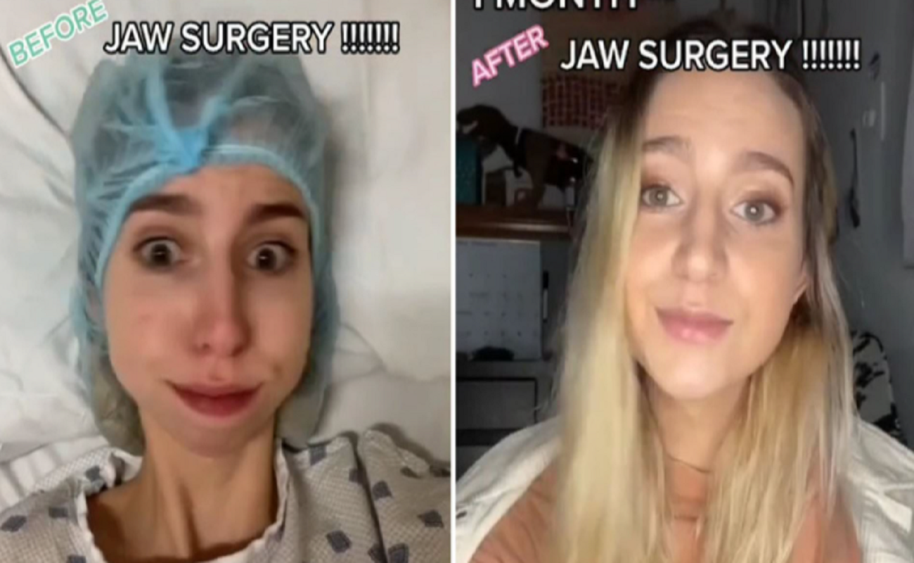 Jaw Surgery TikTok – The Viral Transformation Video | BrunchVirals