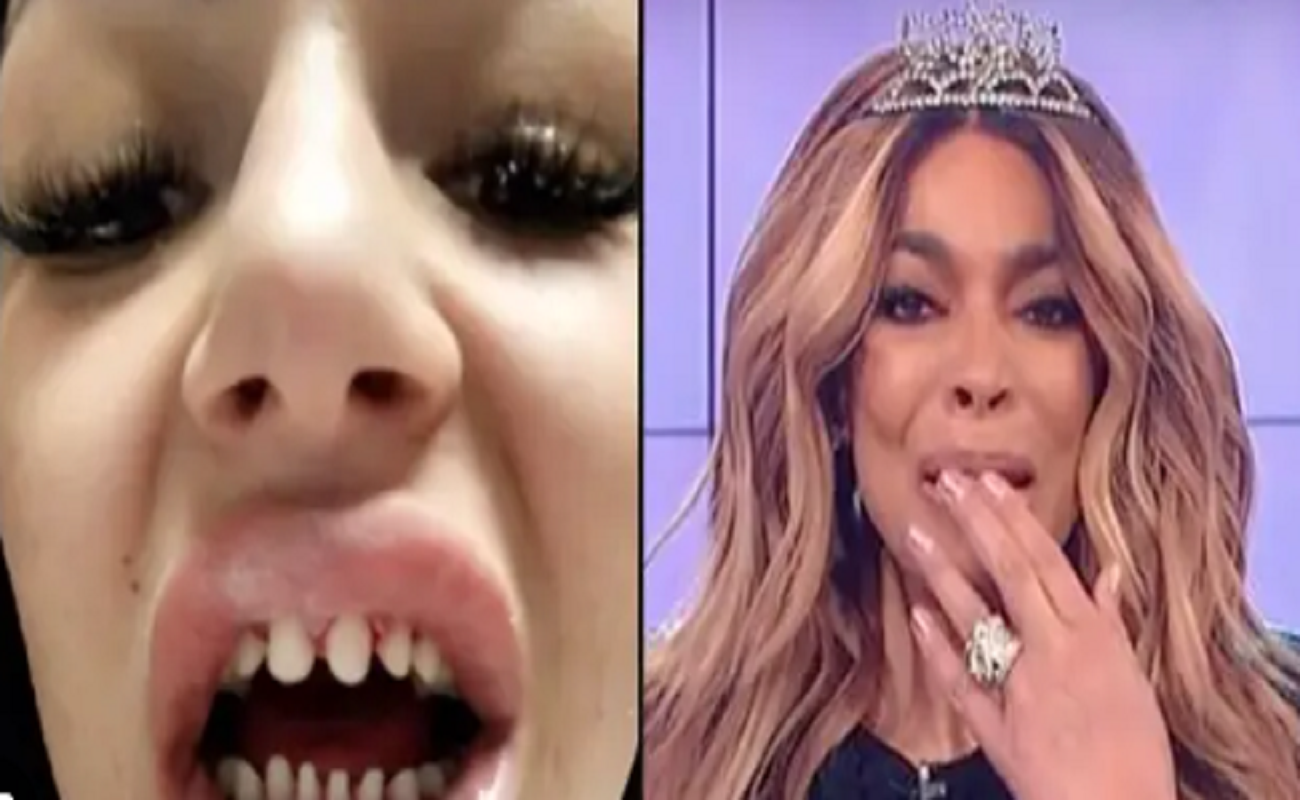 Veneer Viral trend on TikTok - All you need to know | BrunchVirals